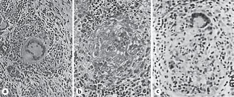 Figure 1 From The Enigma Of Cellular Immunity In Glomerulonephritis