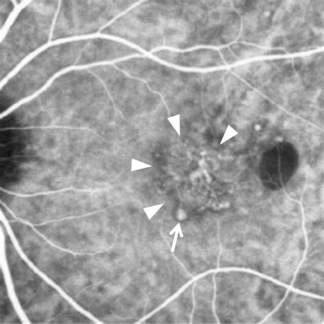 A Representative Figure Showing Polypoidal Choroidal Vasculopathy