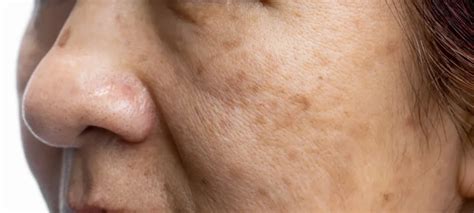 Melasma Derma Advance