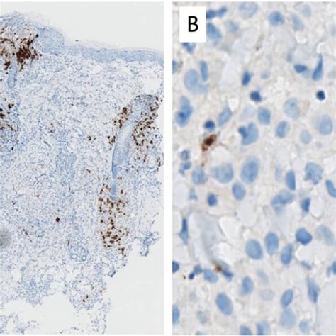 Negative Staining Of Lesional Cells With Langerin Cd207 Which Only