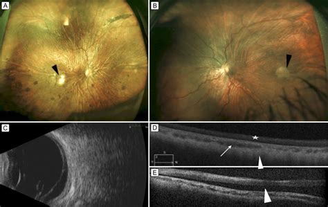 Widefield Fundus Photograph B Scan And Spectral Domain Optical Download Scientific Diagram