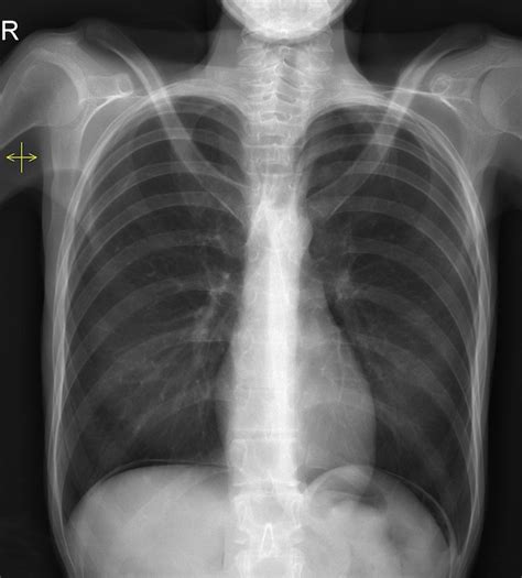 Pneumoperitoneum Erect Cxr Radiology At St Vincents University Hospital