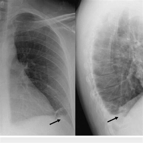 Chest X Ray Shows Increased Haziness Of Left Lower Zone Due To Left Download Scientific Diagram