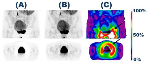 Improved Positron Emission Tomography Quantification Evaluation Of A