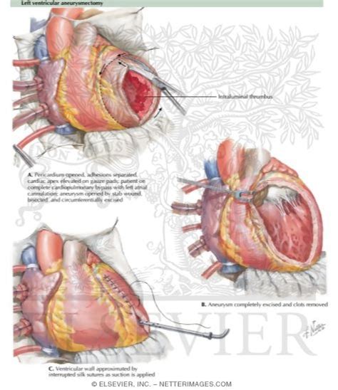 Ventricular Aneurysmectomy