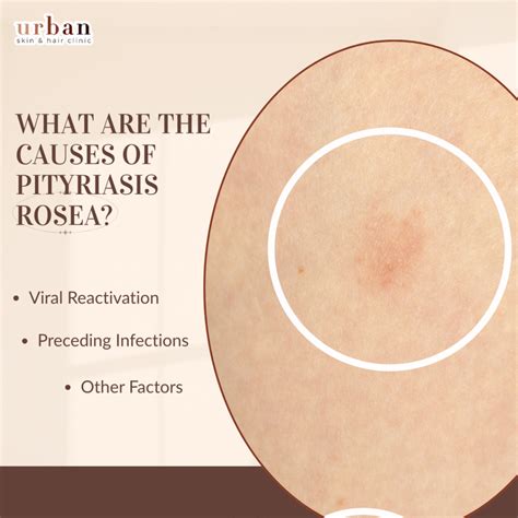 Pityriasis Rosea Types Causes Symptoms And Treatment 2026