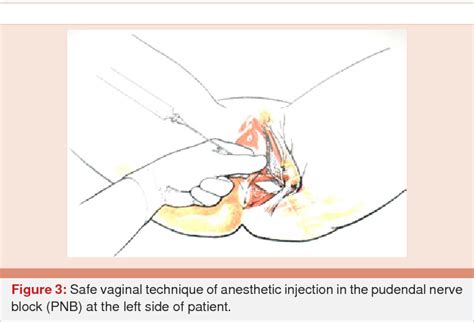 Paracervical Block During Labor