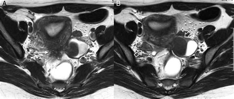Magnetic Resonance Imaging Of Pelvic Endometriosis Radiología