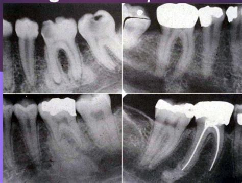 Foh Exam 2 Dental Disease On Radiograph Flashcards Quizlet
