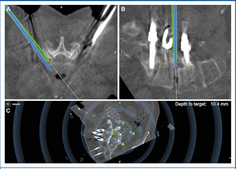 figure 1 from novel merging of ct and mri to allow for safe navigation into kambin s triangle