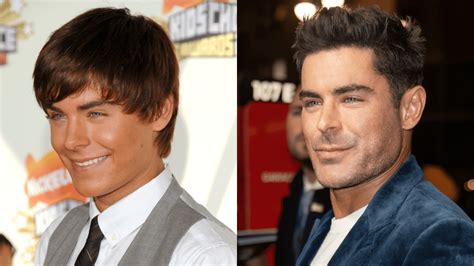 Zac Efron Face Before And After Surgery