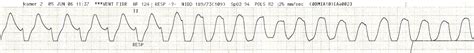 Sine Wave Pattern Arrhythmia And Sudden Paralysis That Result From Severe Hyperkalemia Circulation
