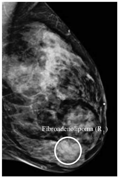 Evaluation Of Image Reconstruction Algorithms For Confocal Microwave Imaging Application To