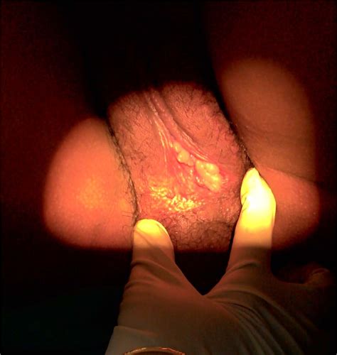 Vaginal Wall Polyps