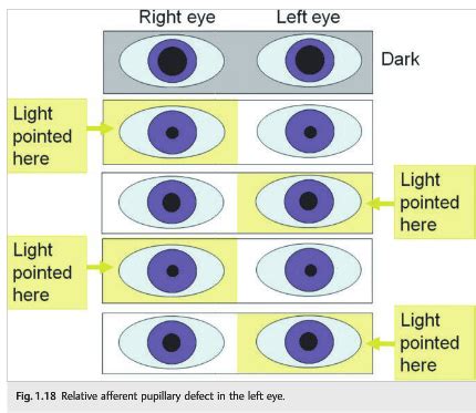 Reverse Afferent Pupillary Defect