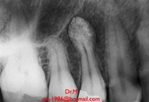 Oral Path Pt 3 Flashcards Quizlet
