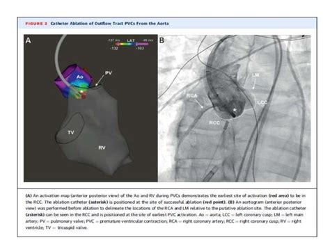 Catheter Ablation In Vt Pptx