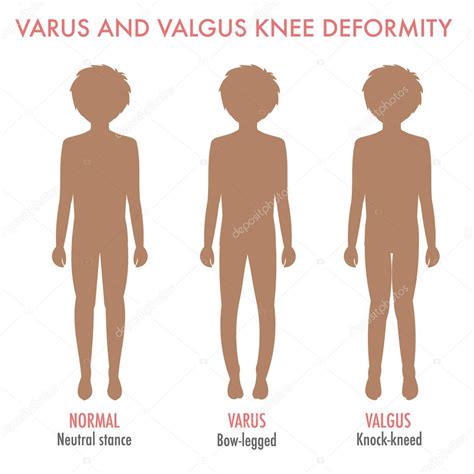Valgus Rodilla Varo Enfermedad De Las Piernas Deformación