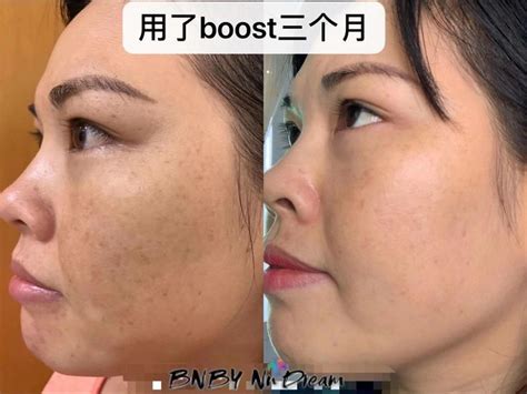 How To Get Rid Of Dark Spots Beauty Devices Nuskin Body Spa