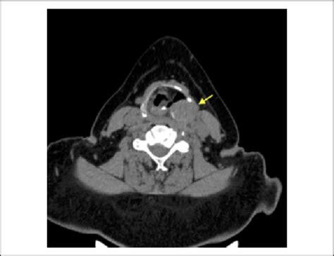 Preoperative Computed Tomography Mass Of Left Piriform Sinus Yellow