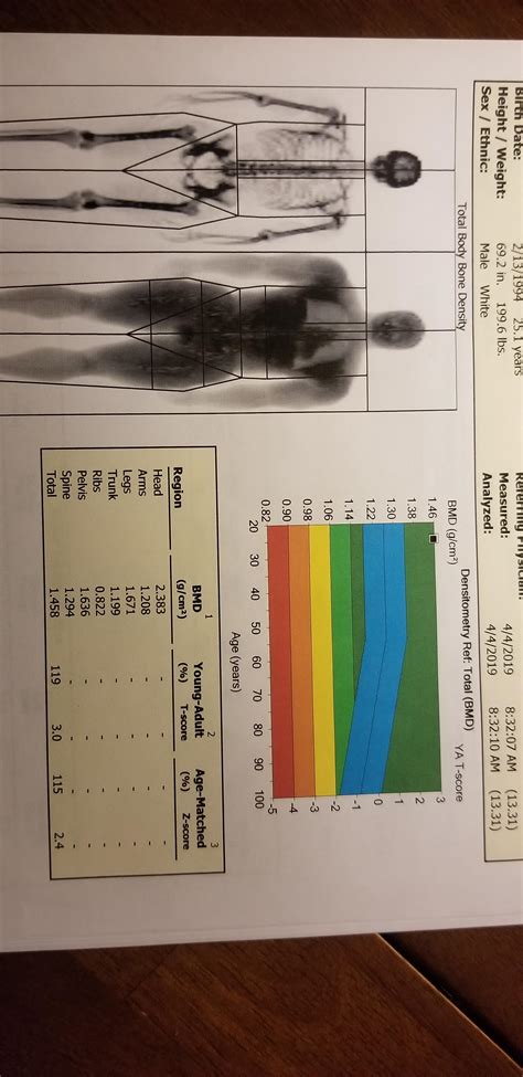 So I Got A Dxa Scan Recently And This Must Be Why Ive Never Broken A