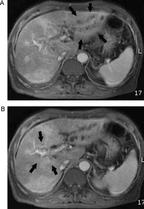Assessment Of Acute Cholangitis By Mr Imaging European Journal Of
