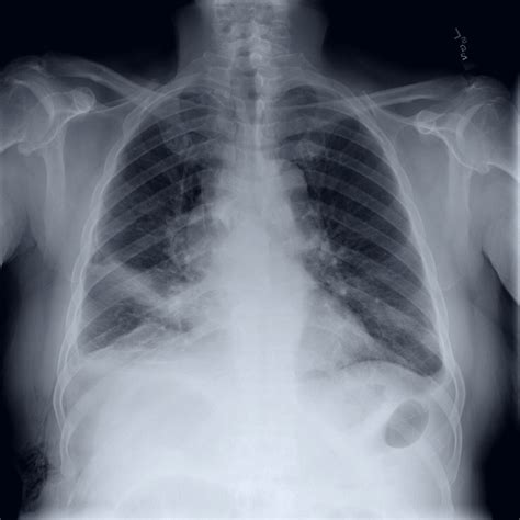 Pneumothorax Segmentation Workspace Weights And Biases
