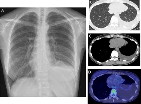 A Chest Radiography Showing A Homogeneous Opacity In The Left Lower