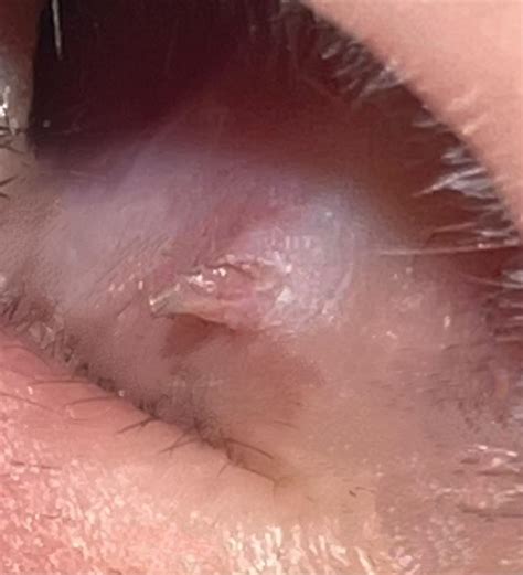 HELP What Is This In My Nose Im Not Sexually Active Could It Be HPV R Skin