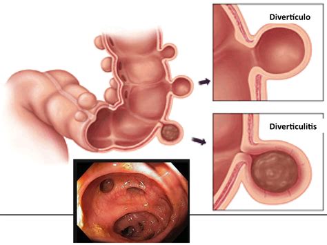 Divertículos En El Colon Diverticulosis Jffa