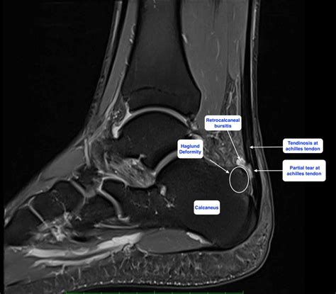 Haglund Deformity Understanding Causes Symptoms And Treatments