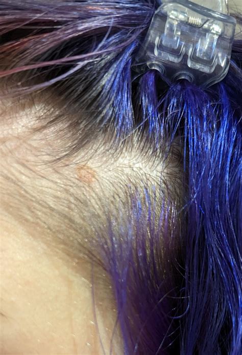 What Is This Redness On My Scalp Possible Ringworm R Dermatology