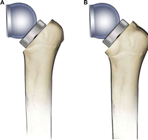 Reverse Shoulder Arthroplasty Design—inlay Vs Onlay Does It Really