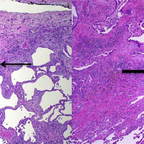 Histopathologic Uip Pattern Low Power Photomicrographs Showing Download Scientific Diagram