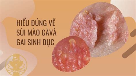 sùi mào gà và gai sinh dục khác nhau như thế nào tuệ y Đường0