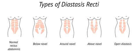 What Does Diastasis Recti Look Like Ryc®