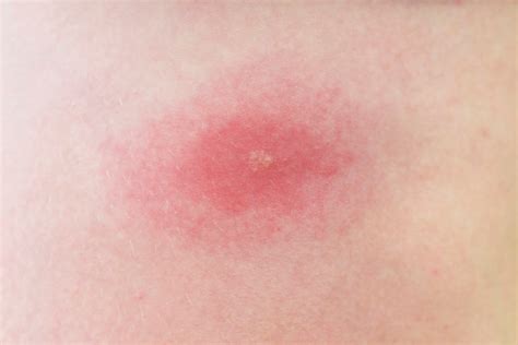 Types Of Bites And Stings Nhs Inform