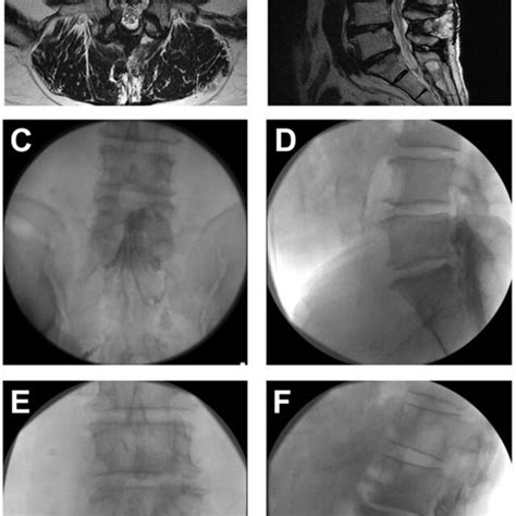 An Inflatable Balloon Catheter Zineu® Juvenui Seoul Korea An Download Scientific Diagram