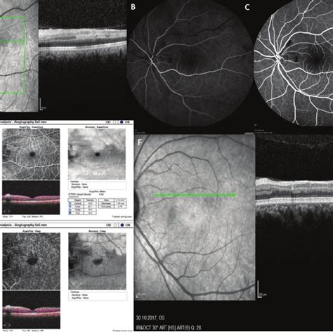 Case A Initial SD OCT Shows A Diffuse Hyperreflective Band Like Download Scientific