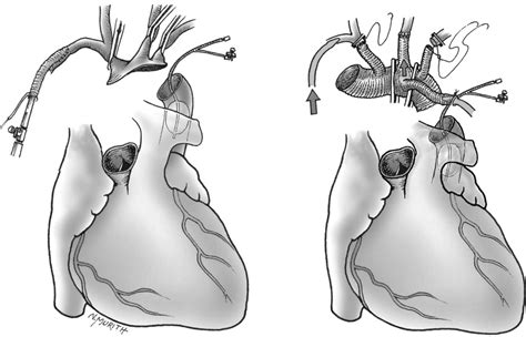Deep Hypothermia Antegrade And Retrograde Cerebral Perfusion