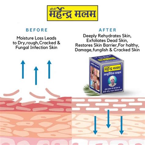Ringworm Ointment 25g At Rs 100 In Surat Id 2851548364733