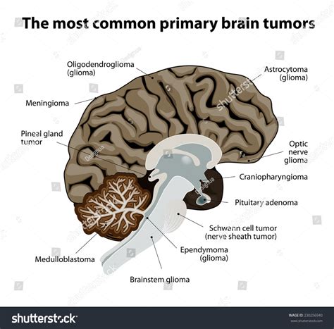 Brain Tumor Diagram