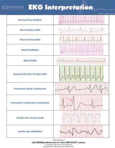 Ekg Cheat Sheet Nursing School Nursing School Tips Nurse