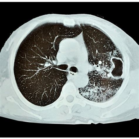 Show Cavitary Lesion Of The Upper Lobe Lung Abscess And The Pedicle