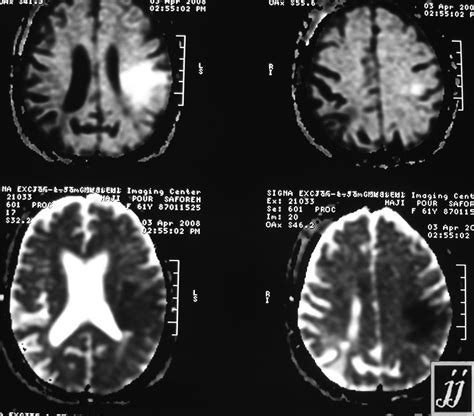 Left Parietal Convexity Cva Radiopaedia