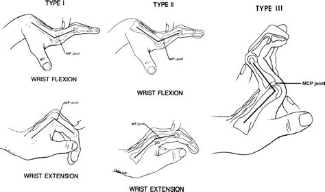 Metacarpophalangeal Joint Extension