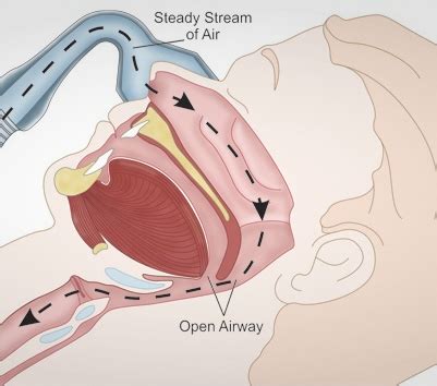 CPAP Therapy ISD Health Solutions Trinidad Tobago Sleep Apnea
