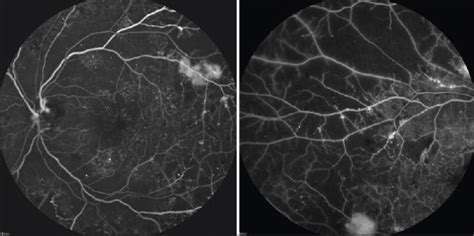 Imaging In Diabetic Retinopathy Pmc