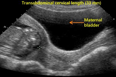 Transvaginal Ultrasound Of The Cervix Ob Images