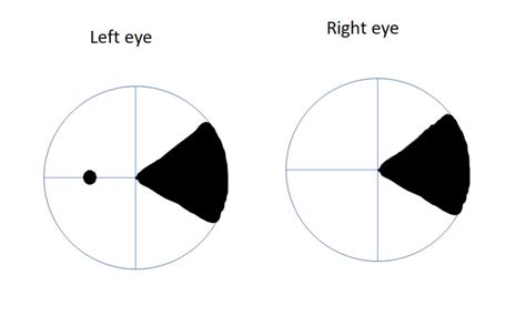 [figure Schematic Diagram Of Right Wedge Shaped ] Statpearls Ncbi Bookshelf